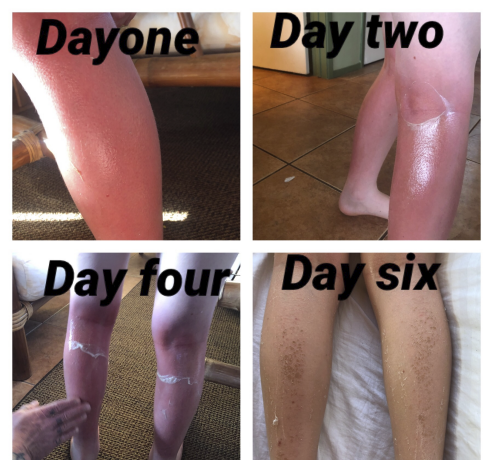 Sunburned Legs Case Study - Silver Biotics